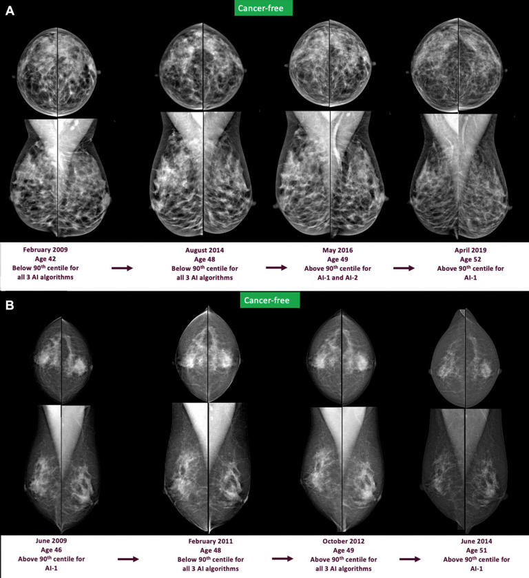 AI could provide early alert for breast cancer 6 years in advance