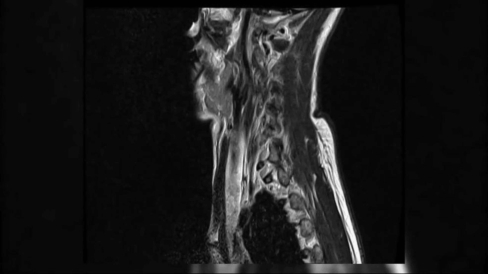 Back on air, Erika Harris opens up on recovery after three-level spine ...