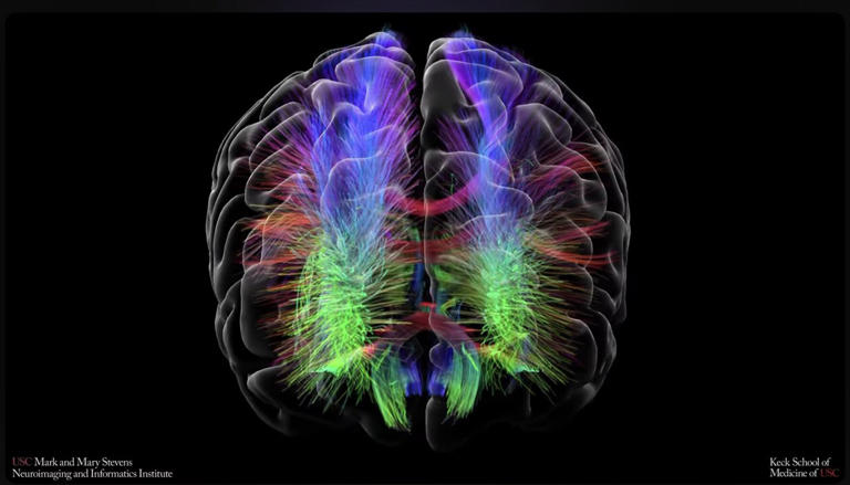Mapping brain network changes linked to bipolar disorder severity and ...