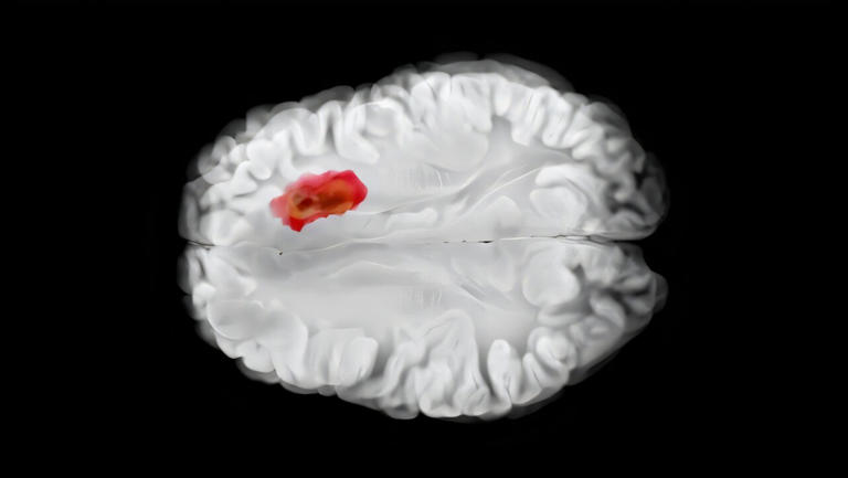 Recurring brain tumors follow two paths, revealing how treatment ...