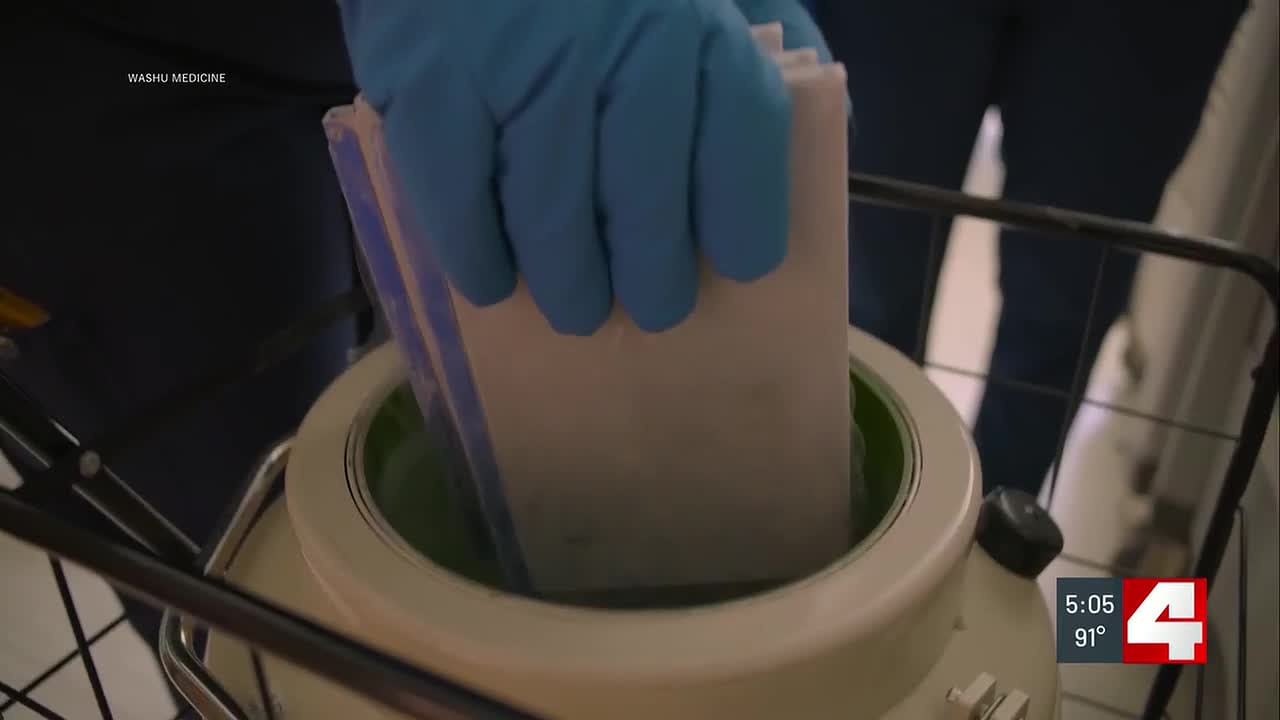 Gene therapy treatment for sickle cell disease changes lives in St. Louis