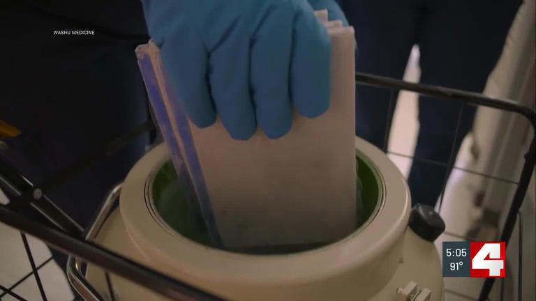 Gene therapy treatment for sickle cell disease changes lives in St. Louis