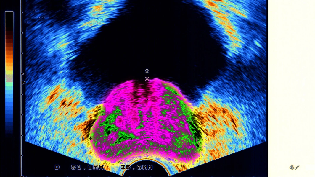 AI and imaging advances reshape prostate cancer detection
