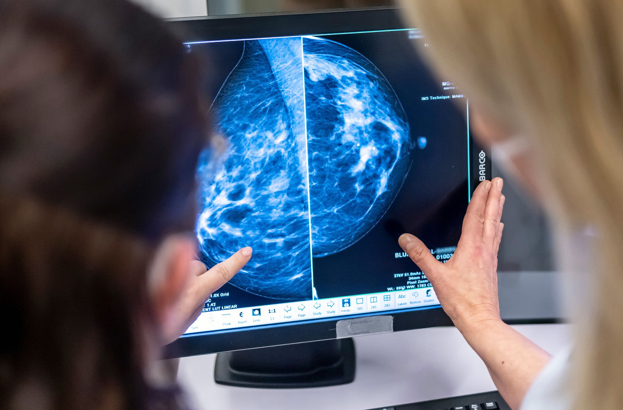 Breast cancer study: Lymph nodes changes could reveal who is at risk