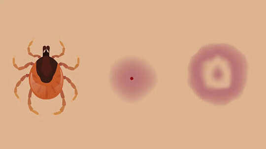 US doctors sound alarm on alpha-gal syndrome as tick bite cases climb