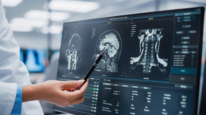 Myths you should stop believing about strokes