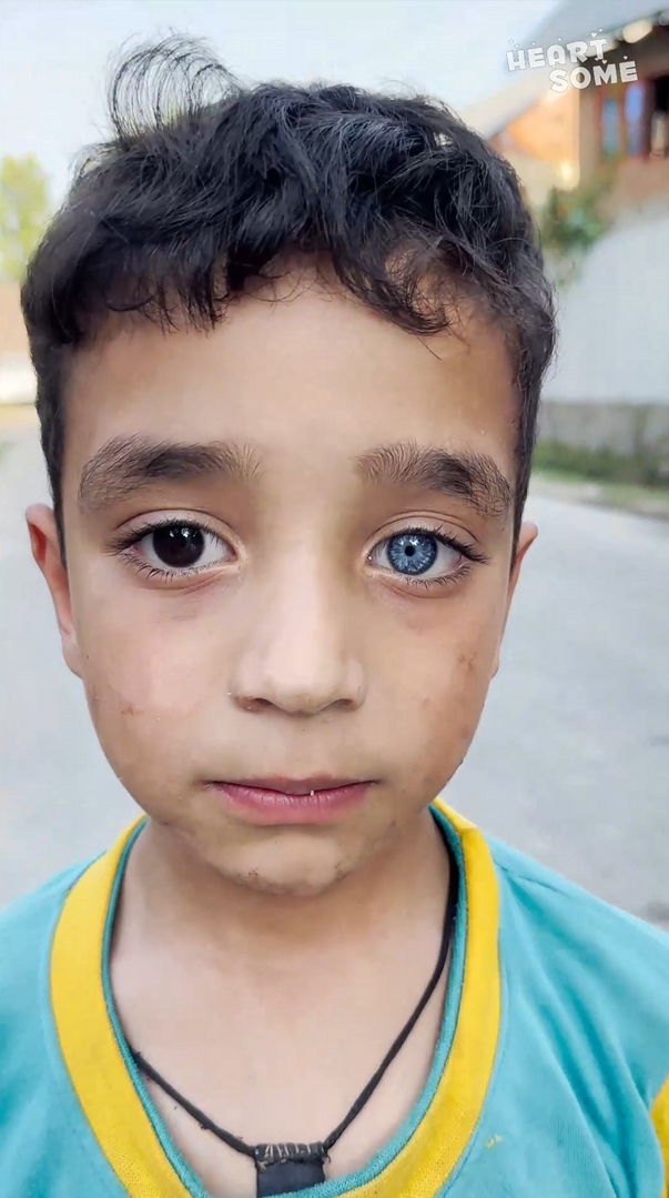 Boy with heterochromia captures hearts with his unique charm