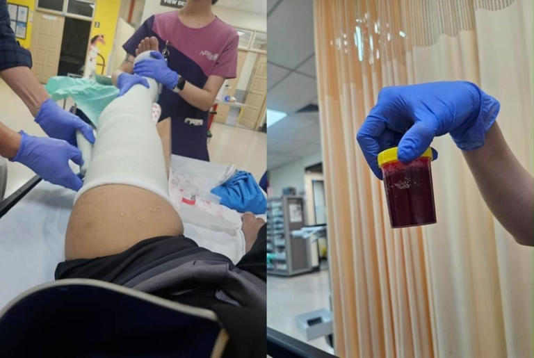 Man breaks leg after alleged impact from world's largest tipping bucket ...