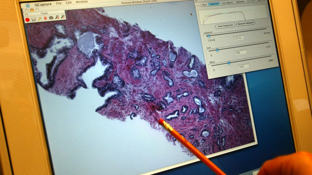 Mayo Clinic maps meningioma at single-cell resolution
