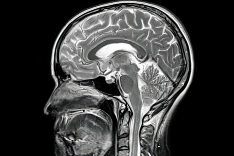 Joint pain supplement taken by millions may speed up Alzheimer's ...