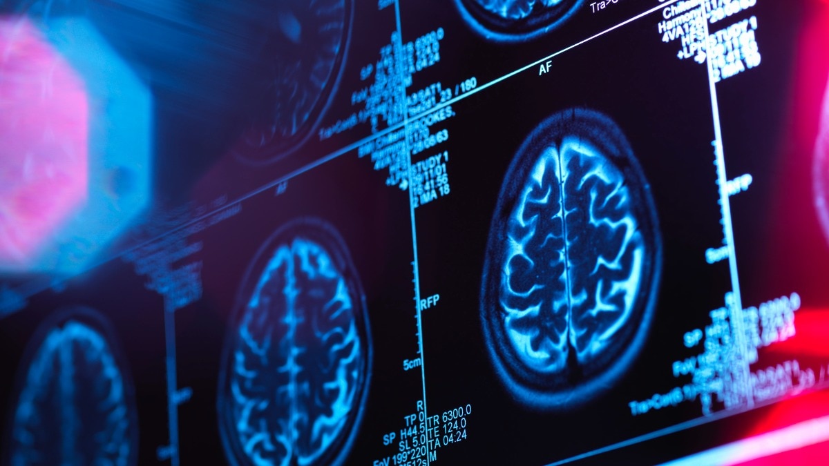 Woman with Alzheimer's sees major improvements after taking magic mushrooms