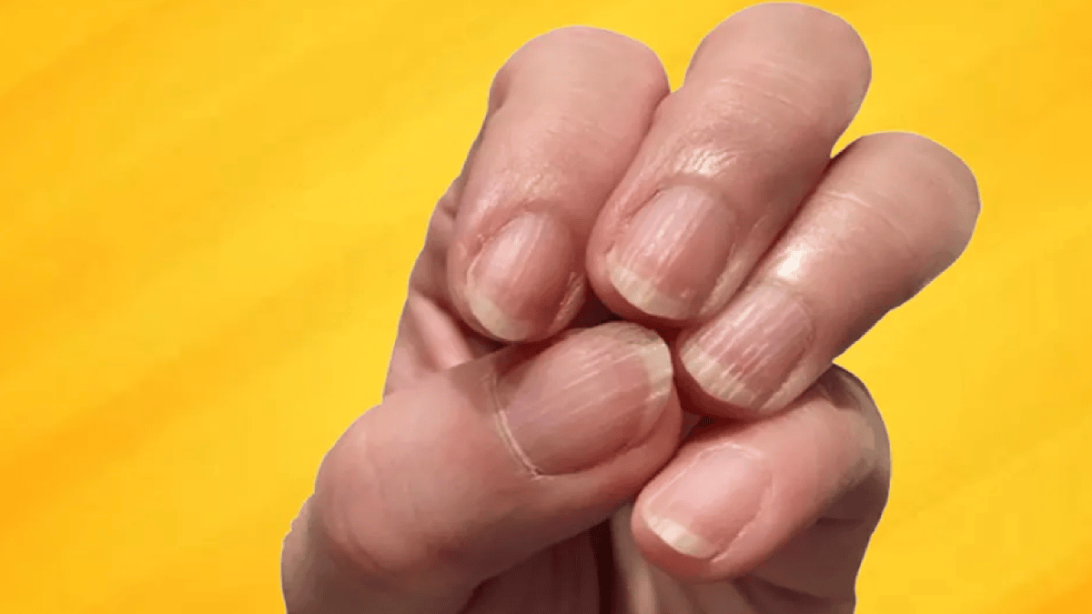 Vertical nail ridges have you worried? Here is what my doctor told me ...