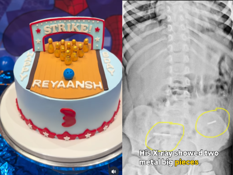 Birthday horror! 3-year-old swallows metal wires hidden in cake ...