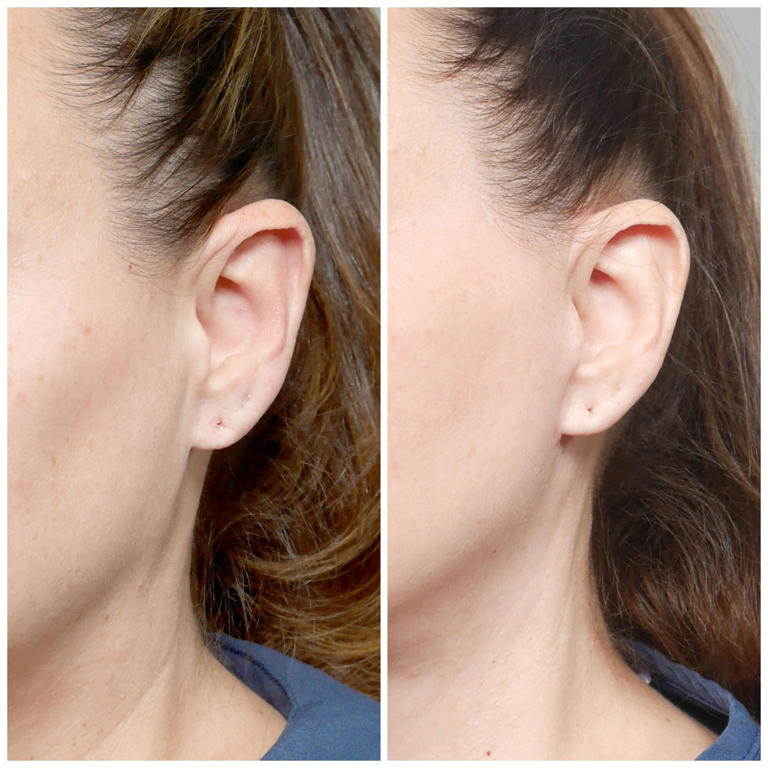 GLP-1 patients pay $9,500 for 'Ozempic ear' surgery