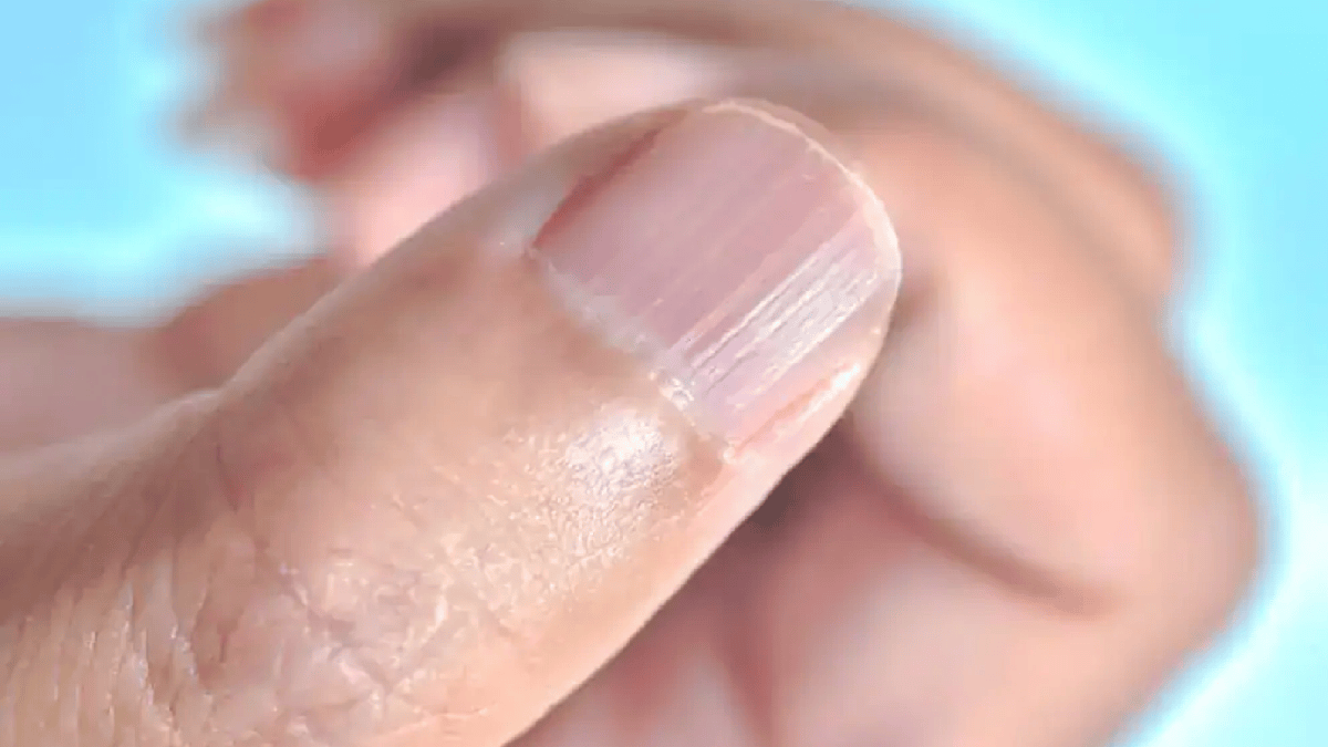 Vertical nail ridges have you worried? Here is what my doctor told me ...