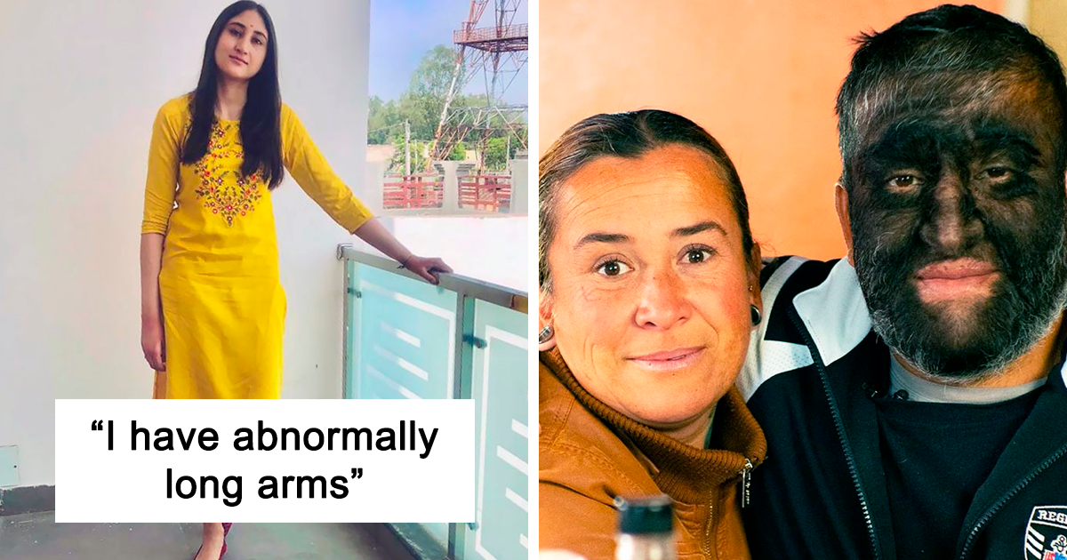 43 people with rare genetic traits that stand out instantly