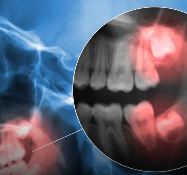 Dentes do siso: por que essa herança da evolução ainda faz parte do ...