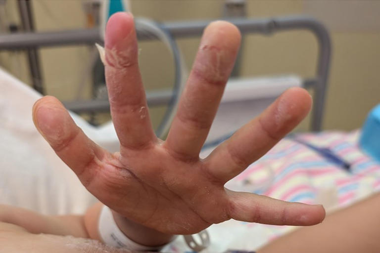 Lydia caught the flu. Two weeks later, she was fighting for life