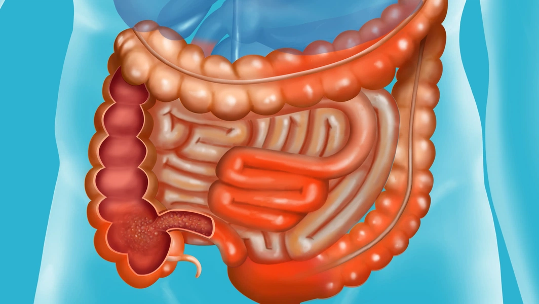 Living better with inflammatory bowel disease