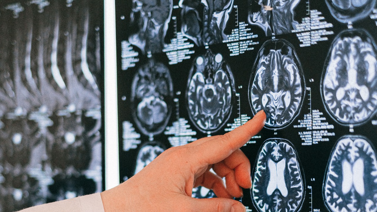 Scientists found two biologically distinct types of autism, each with ...