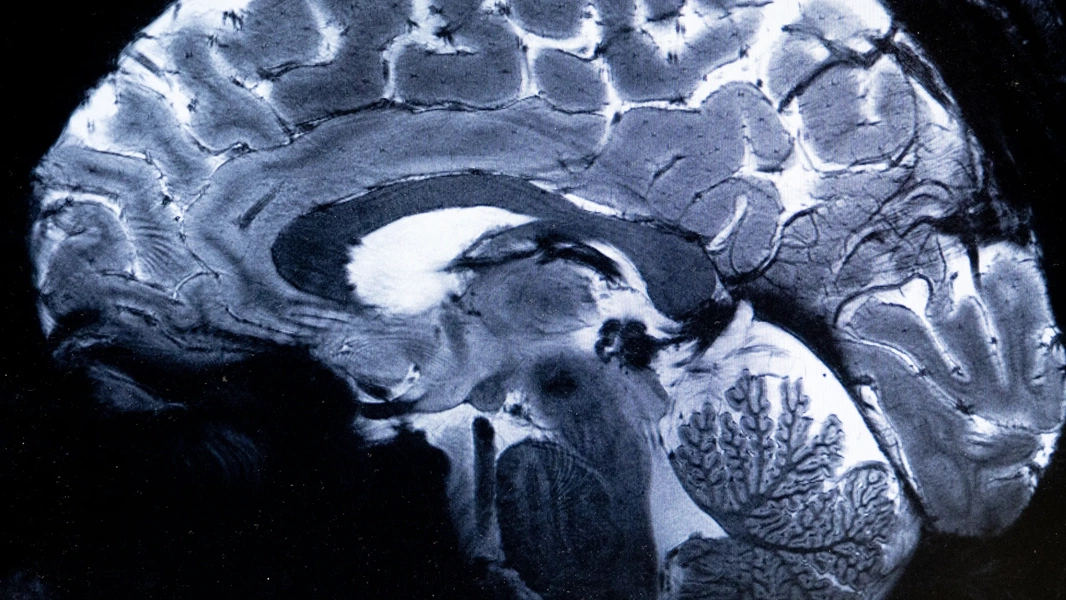 Low vitamin C linked to brain shrinkage and weaker connectivity