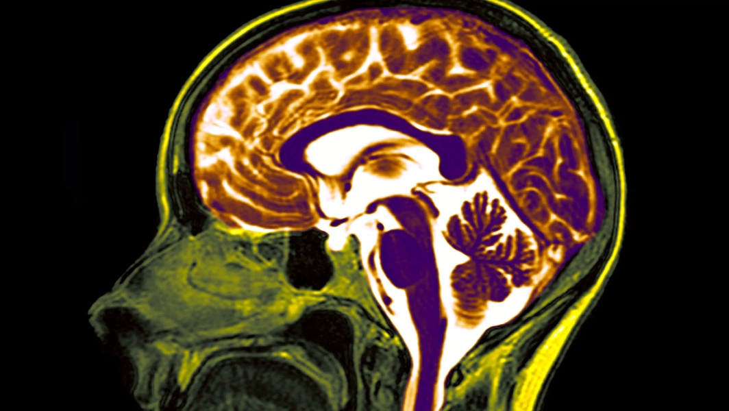 Low vitamin C linked to brain shrinkage and weaker connectivity