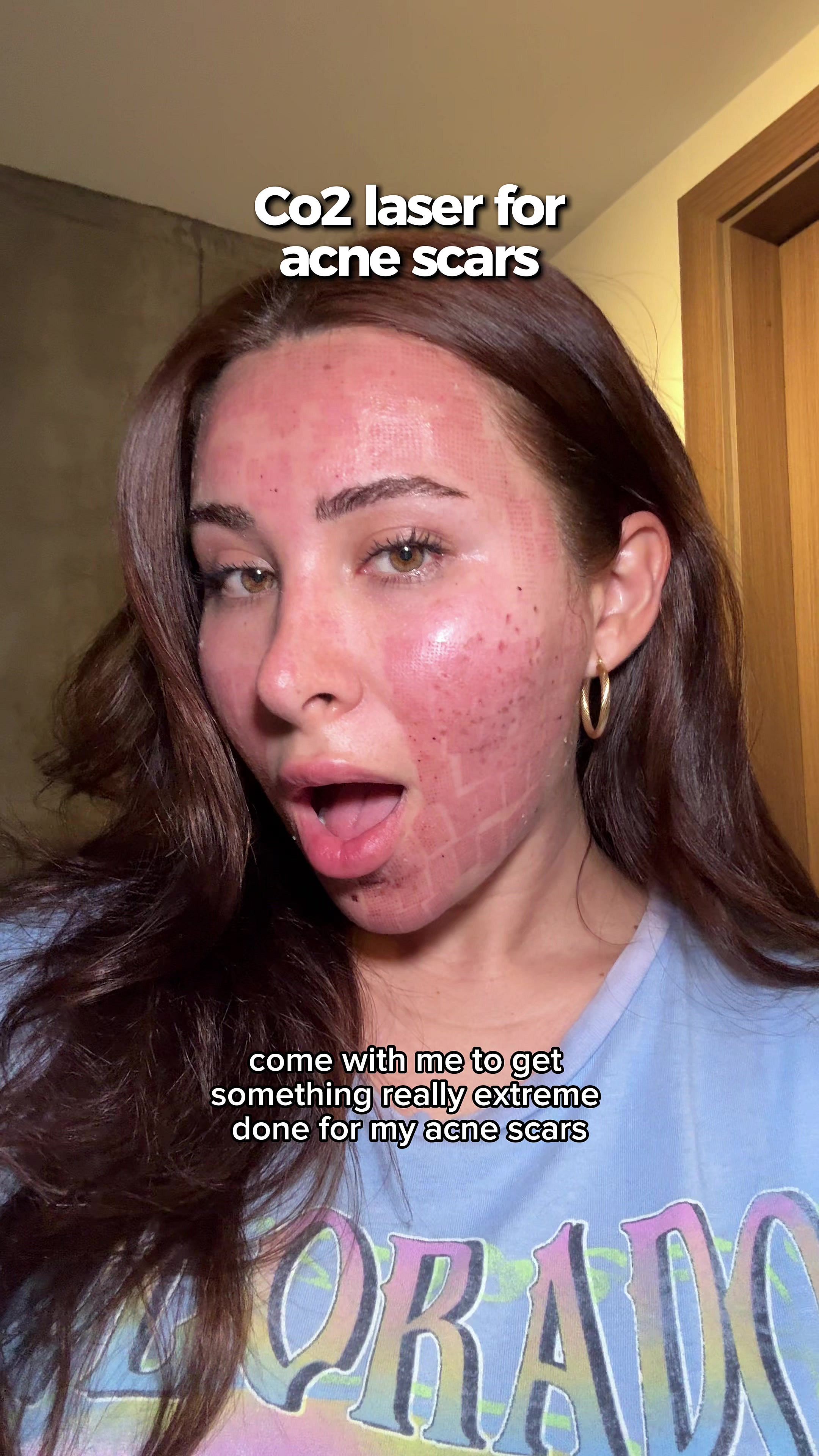 This laser treatment looks intense but the results are incredible