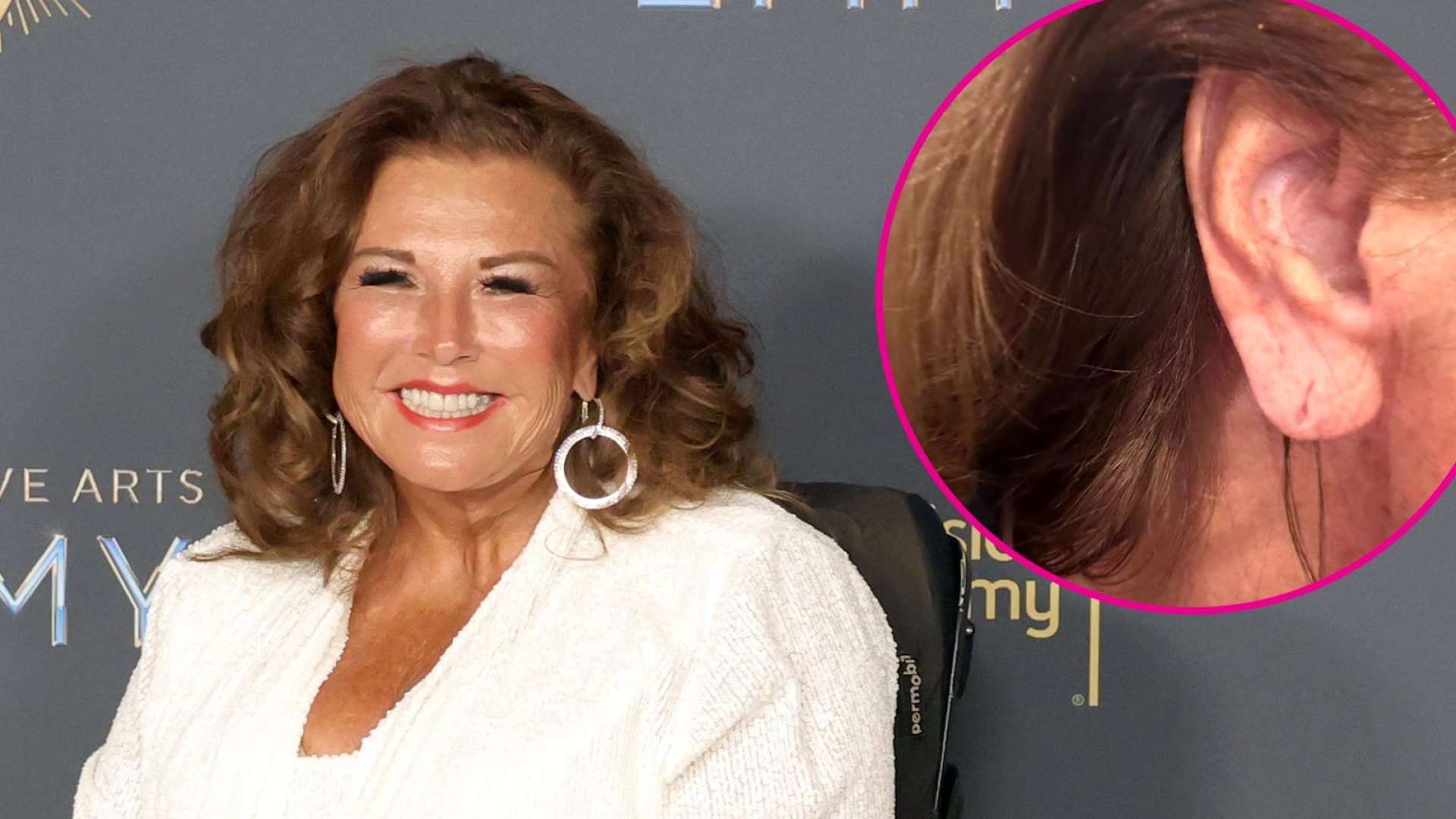 Abby Lee Miller shows off results of $1K ear rejuvenation procedure