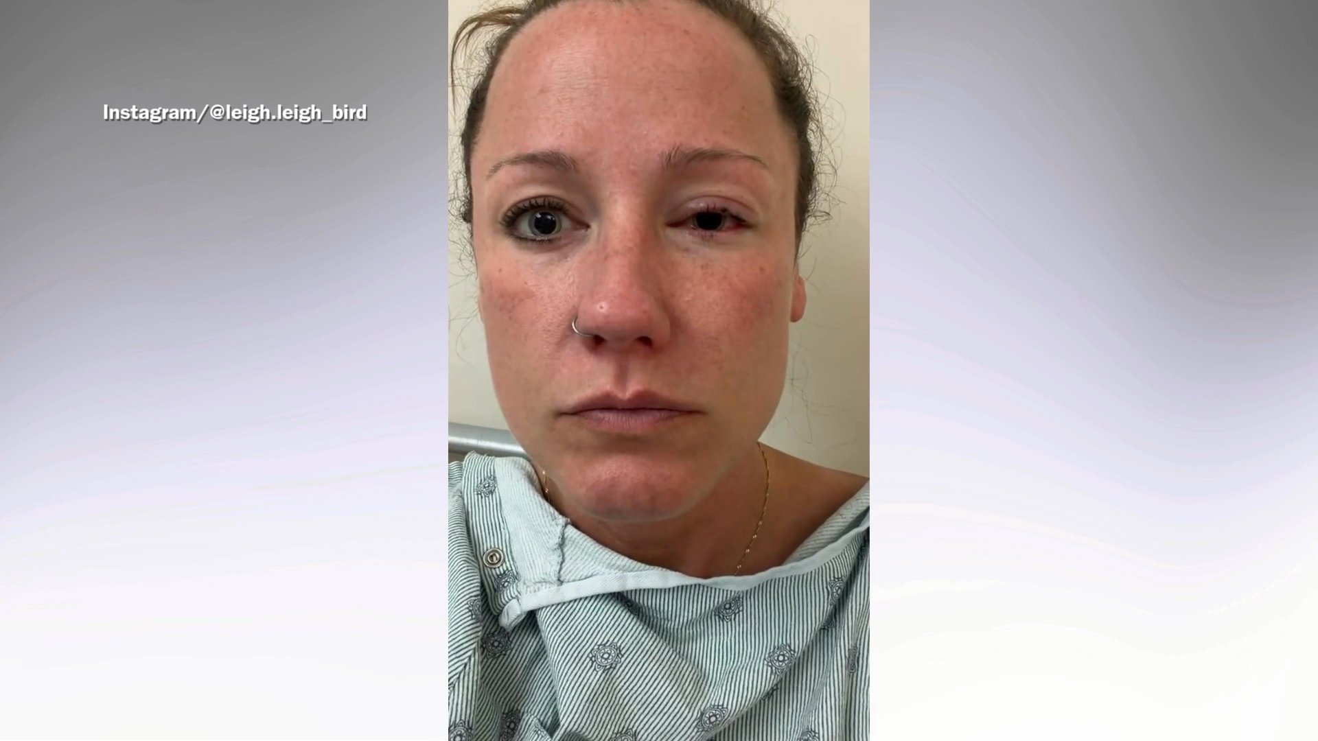 Woman suffers chemical burns after using nail glue instead of eye drops