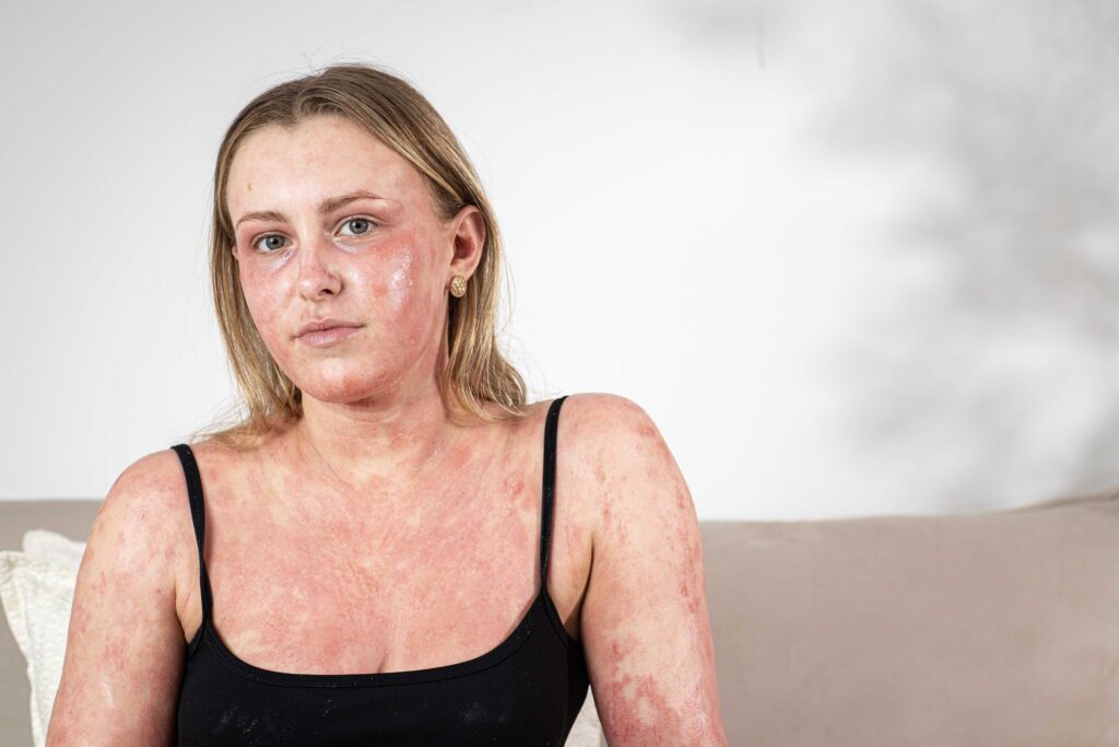 Woman says common eczema treatment ruined 95% of her skin