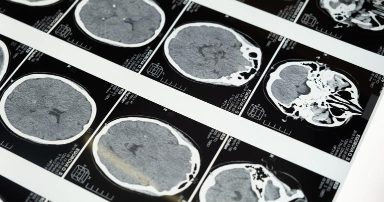 Three common sleep habits linked to faster brain aging