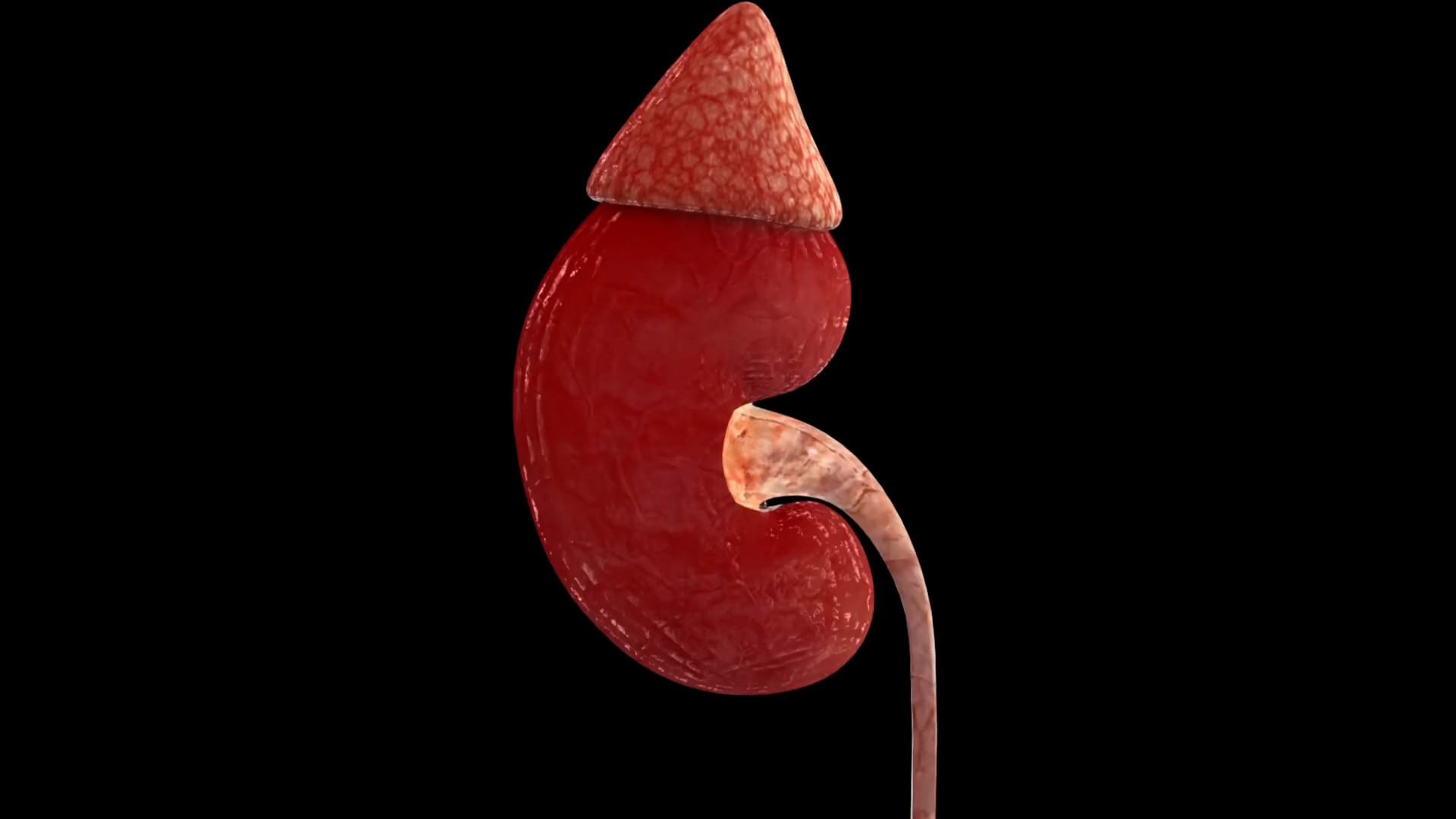 The hidden cause of have a kidney stone most people miss