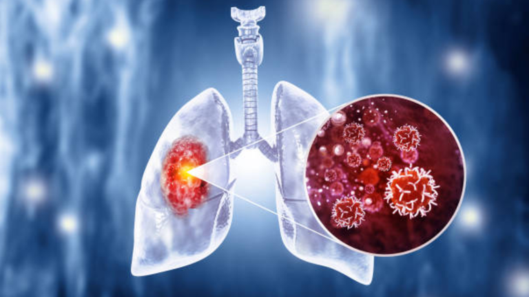 When lung cancer progressed despite treatment, a genomic clue helped ...