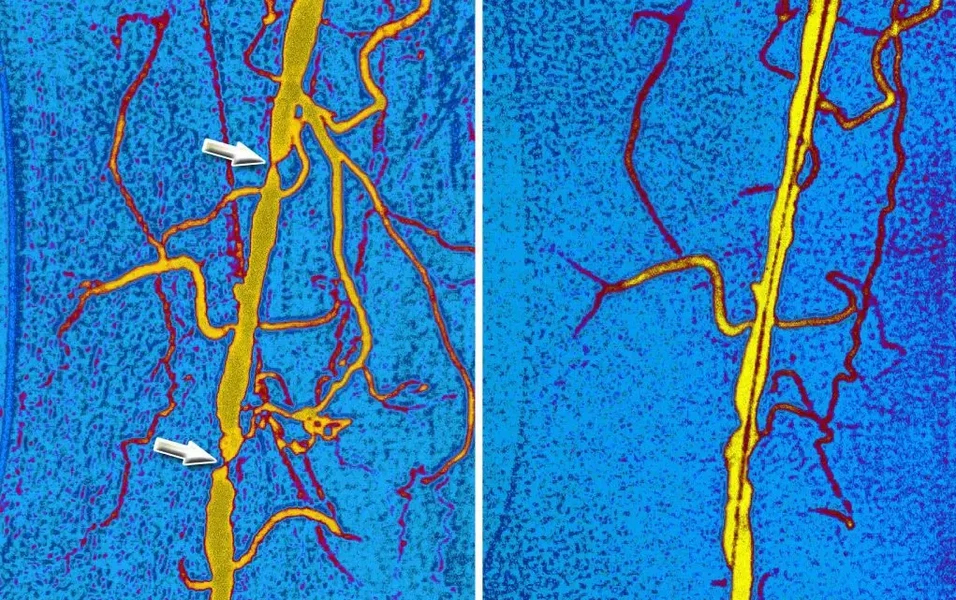 Doctors trigger fake angina to pinpoint stent benefits