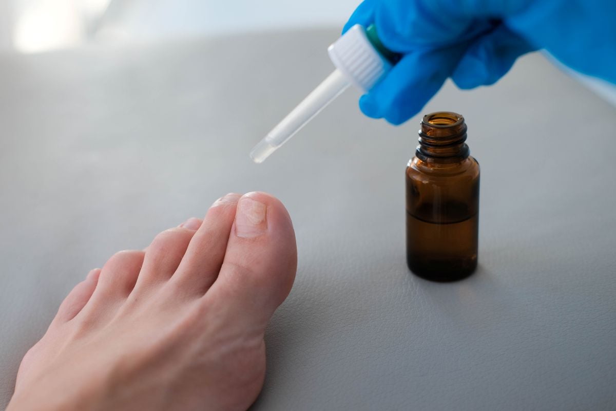Mycose de l’ongle : pourquoi elle ne guérit jamais seule et les ...