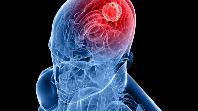 India's brain cancer breakthrough? High-grade glioma survival jumps by ...