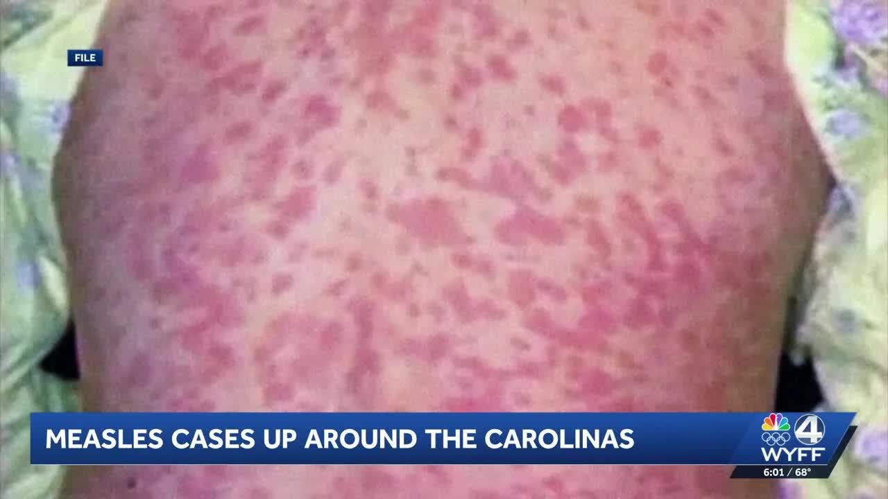 Measles outbreak in the Upstate leads to increased vaccinations; Faith ...