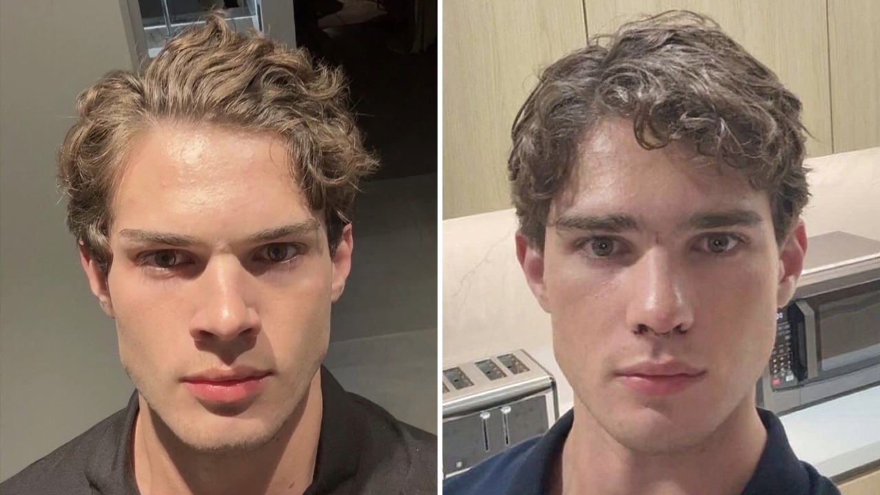 Looksmaxxing influencer Clavicular faces criticism over new nose: 'Too ...