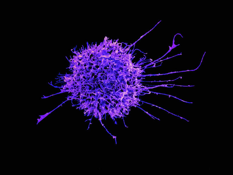 Supercharged natural killer cells suppress solid tumors in mice