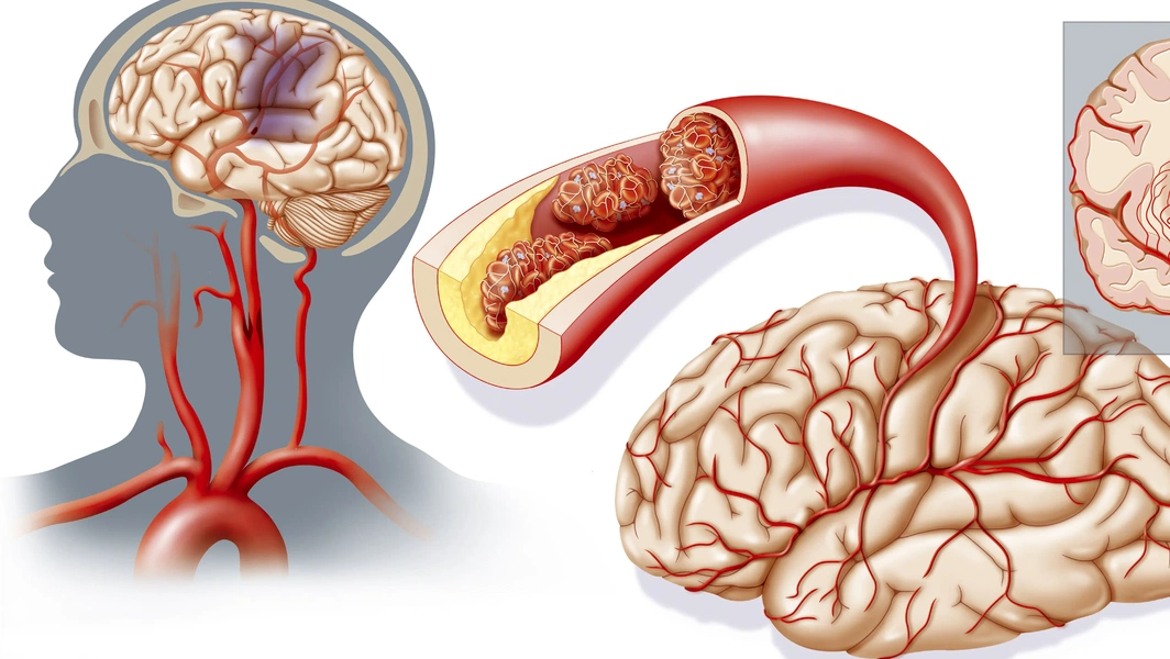 Recognizing early and silent stroke warning signs