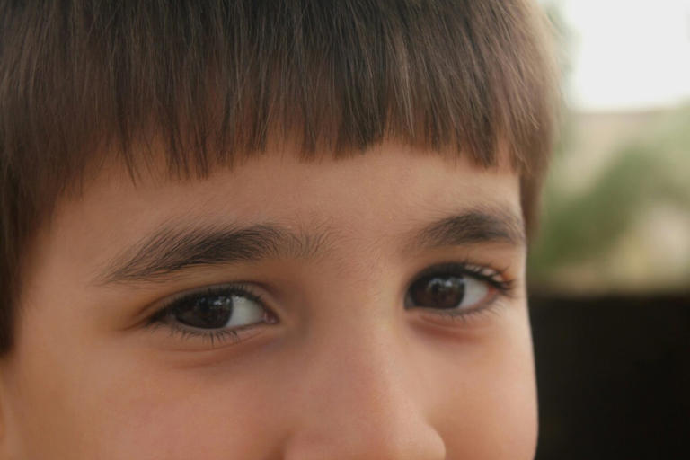 Low dose atropine eye drops safe and effective for short-sightedness in ...