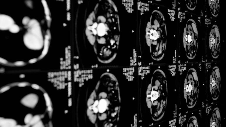 Brain haemorrhage vs stroke: Understanding the difference could save a life