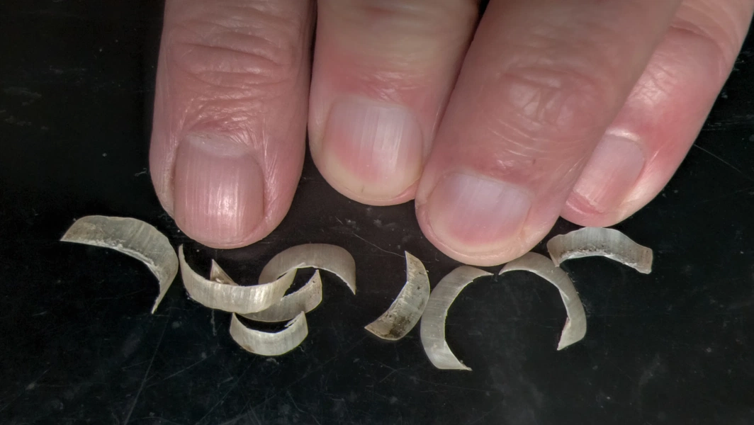 Causes and meanings of nail ridges