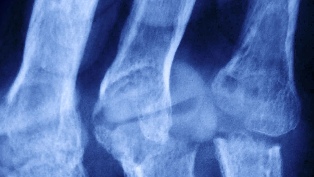 How rheumatoid arthritis affects the whole body
