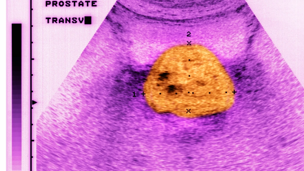 Experts push MRI-based prostate cancer screening after policy rejection