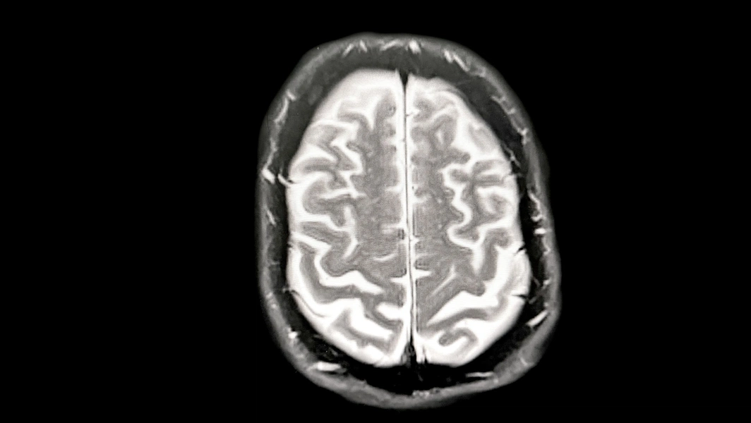 Sleep disturbances linked to early Alzheimer’s