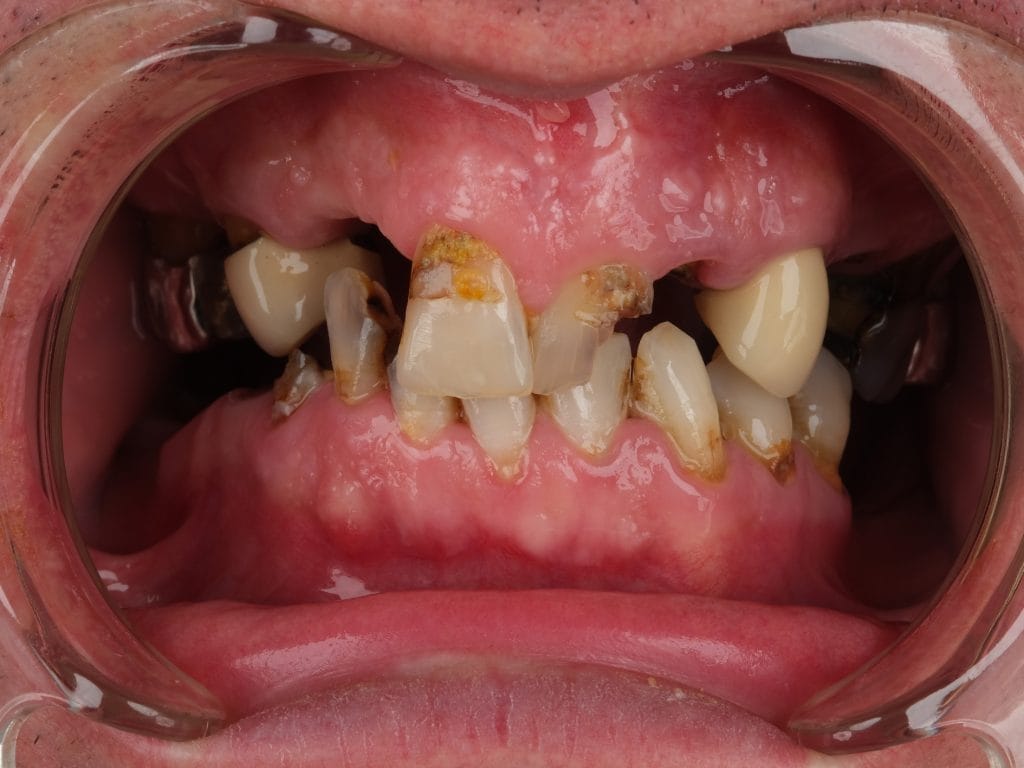 Case study: Brit gets his smile back and a functional bite for a ...