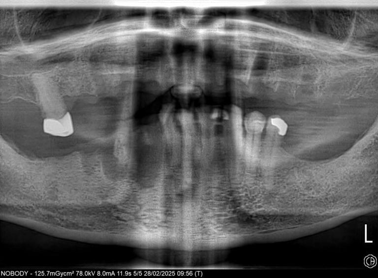 Case study: Brit gets his smile back and a functional bite for a ...