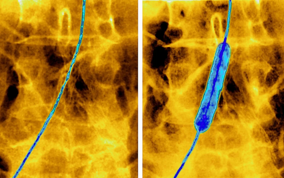 Doctors simulate angina to refine stent treatment decisions