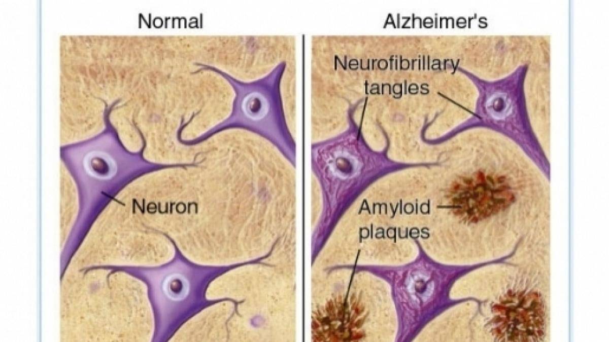 Alzheimer e riduzione delle placche: i benefici di Donanemab e le ...